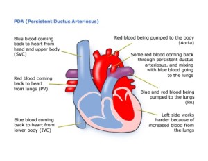 Children's Heart Federation | Persistent Ductus Arteriosus (PDA)