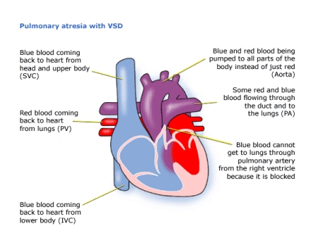 Children's Heart Federation | Pulmonary Atresia