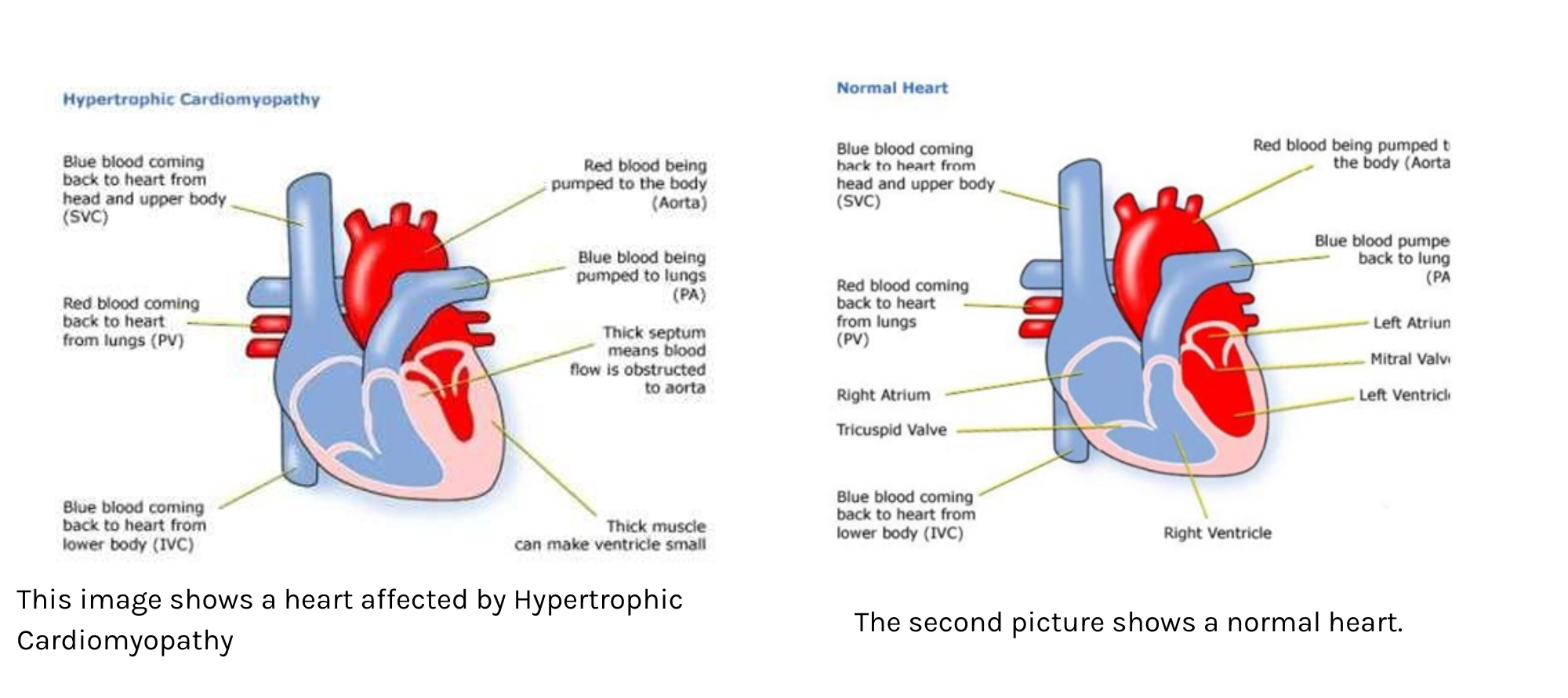 Children's Heart Federation | Heart Conditions in Children ...