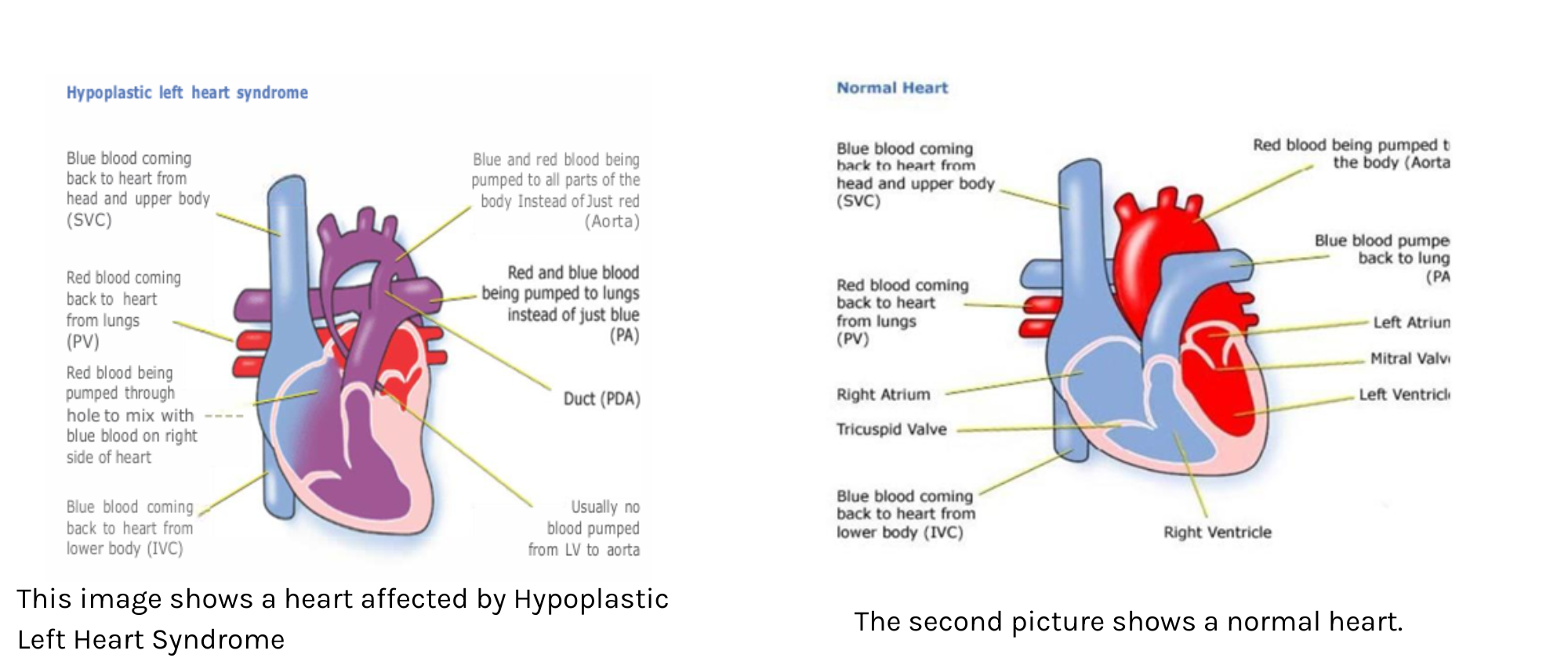 Children's Heart Federation | Heart Conditions in Children ...