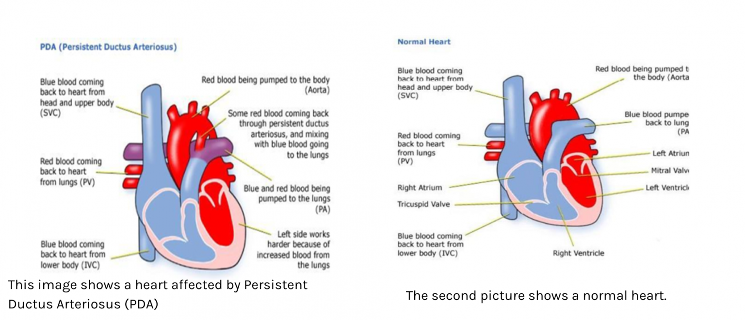 Children's Heart Federation | Heart Conditions in Children – Persistent ...