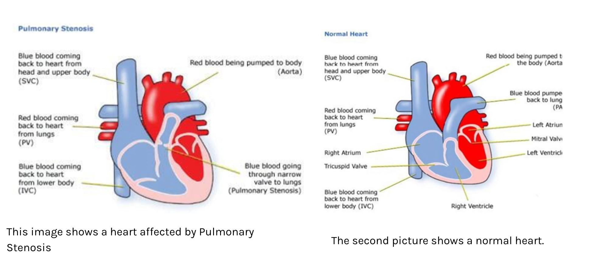 Children's Heart Federation | Heart Conditions in Children – Pulmonary ...