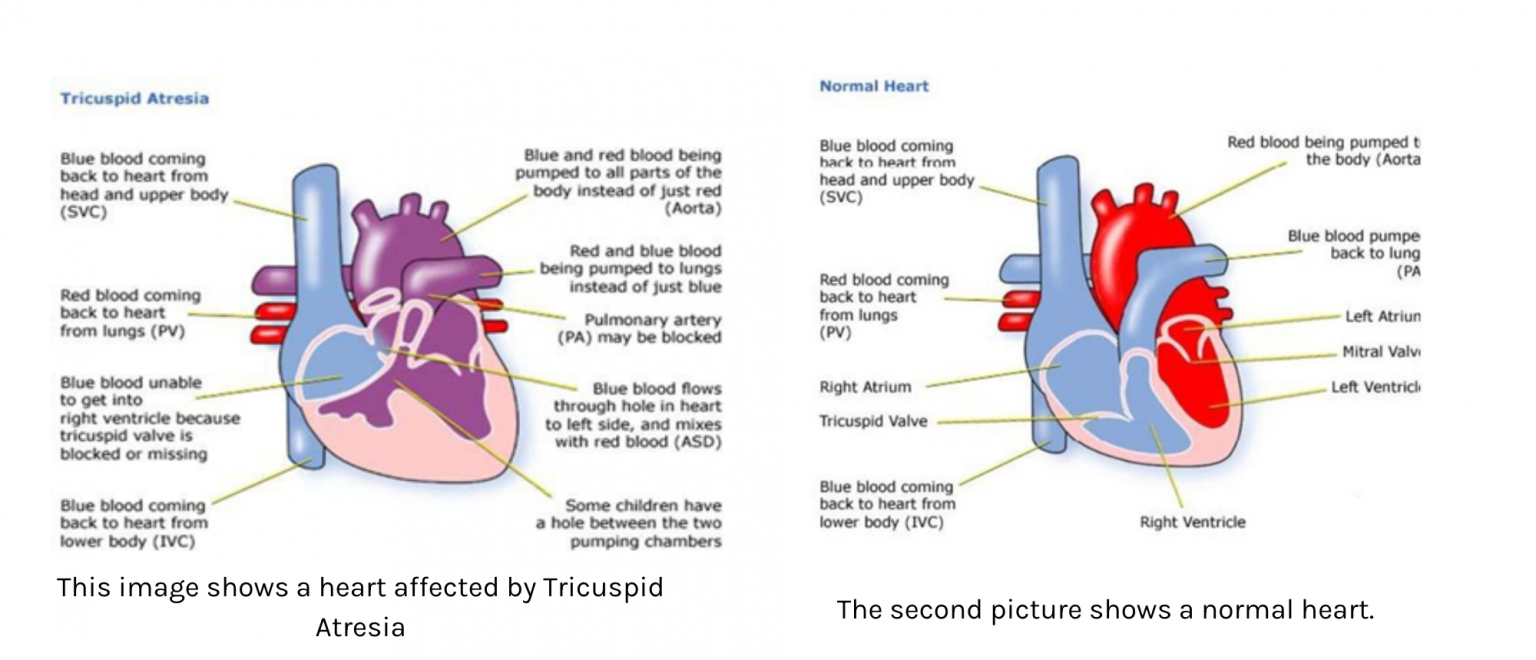 Children's Heart Federation | Heart Conditions in Children – Tricuspid ...