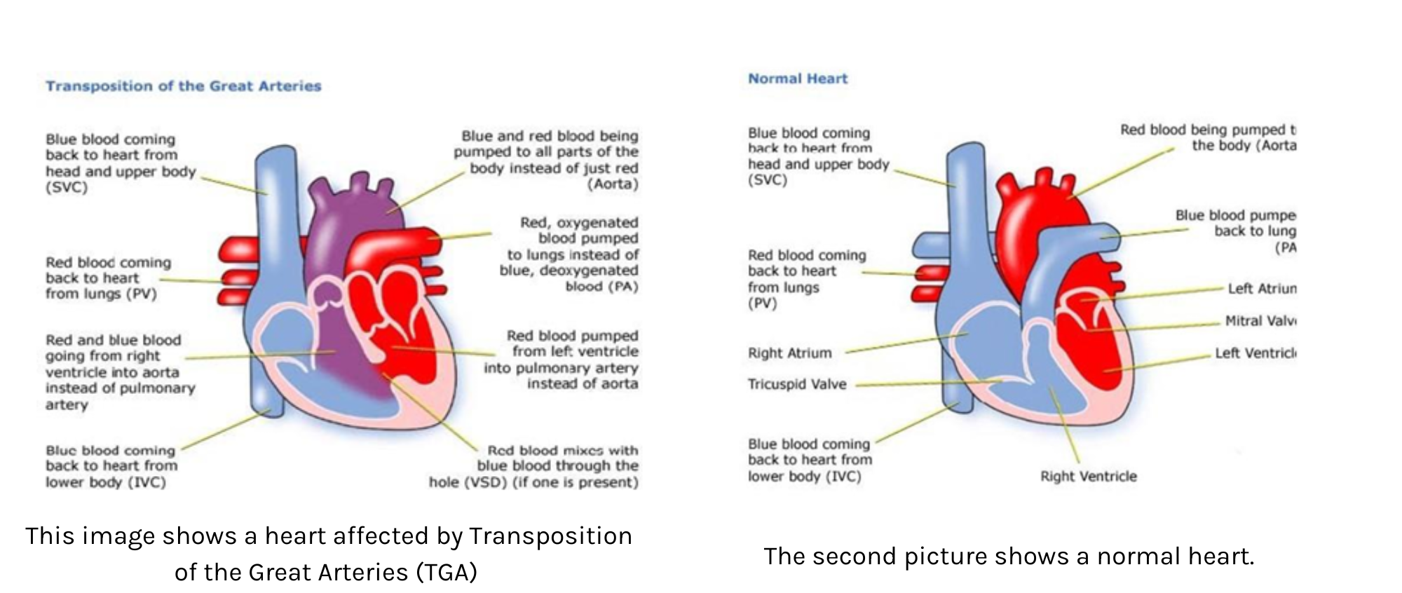 Children's Heart Federation | Heart Conditions in Children ...
