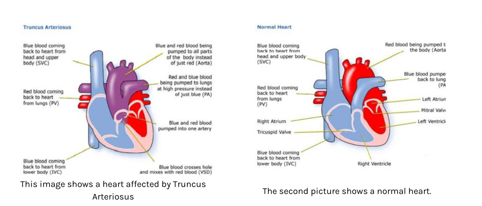 Children's Heart Federation | Heart Conditions in Children – Truncus ...