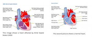 Children's Heart Federation | Heart Conditions in Children – Atrial ...