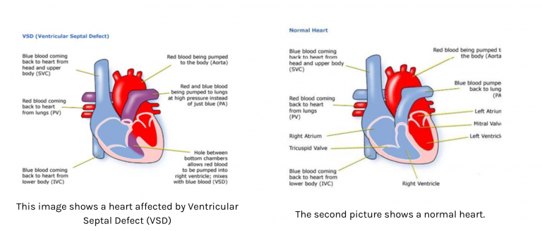 Children's Heart Federation | Heart Conditions in Children ...