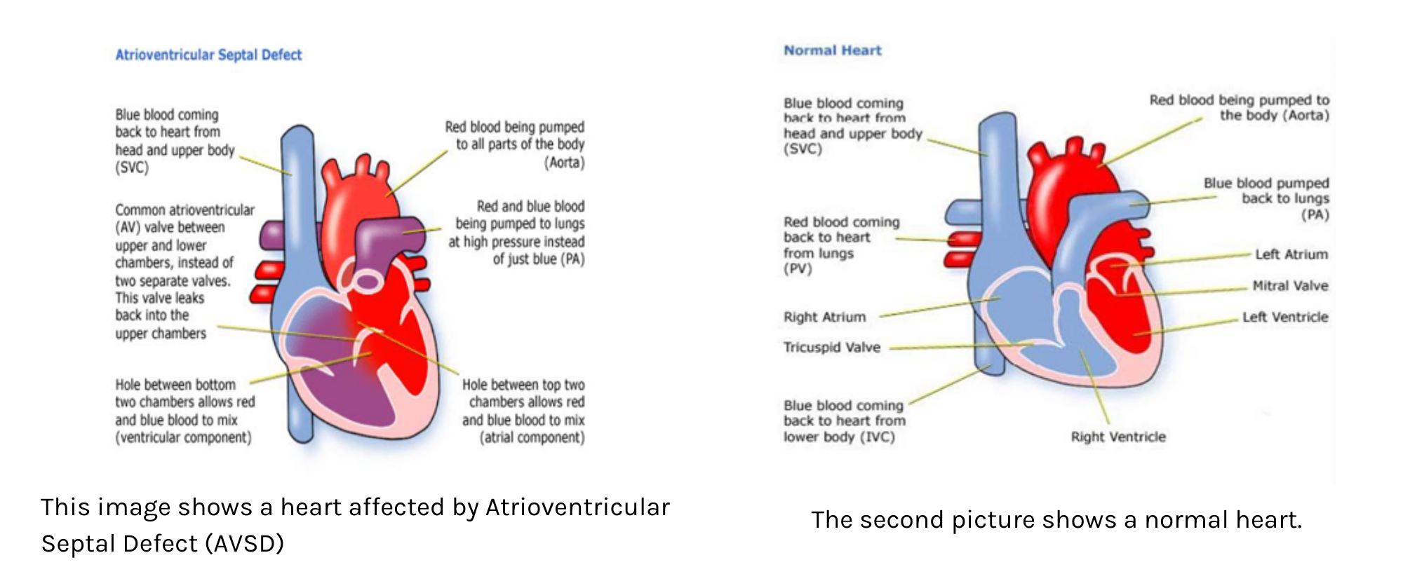 Children's Heart Federation | Heart Conditions in Children ...