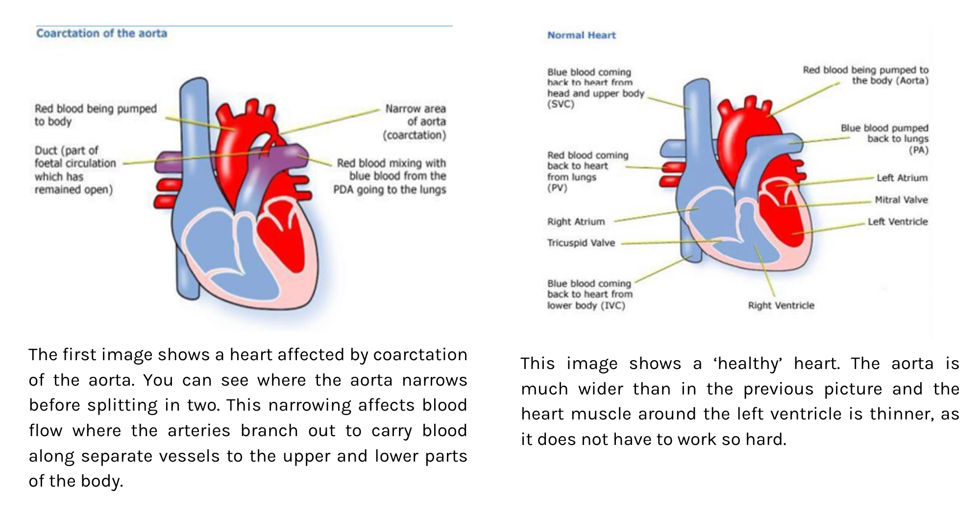 Children's Heart Federation | Heart Conditions in Children ...