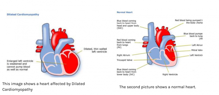 Children's Heart Federation | Heart Conditions in Children – Dilated ...