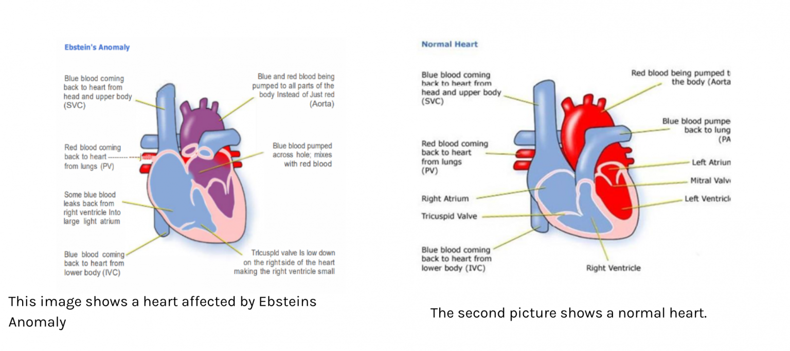 Children's Heart Federation | Heart Conditions in Children – Ebsteins ...